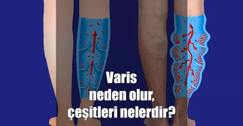 Varis - IDEA TIP - Tıbbi Bilgiler ve İpuçları Sunan Sağlık Sitesi