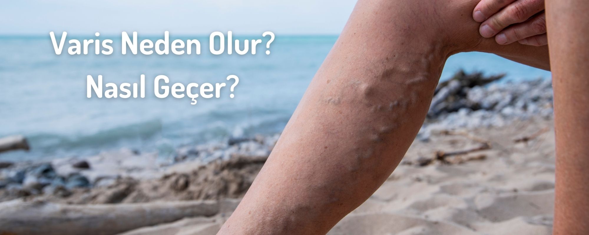 Varis Hastalığı İle İlgili Merak Edilenler.